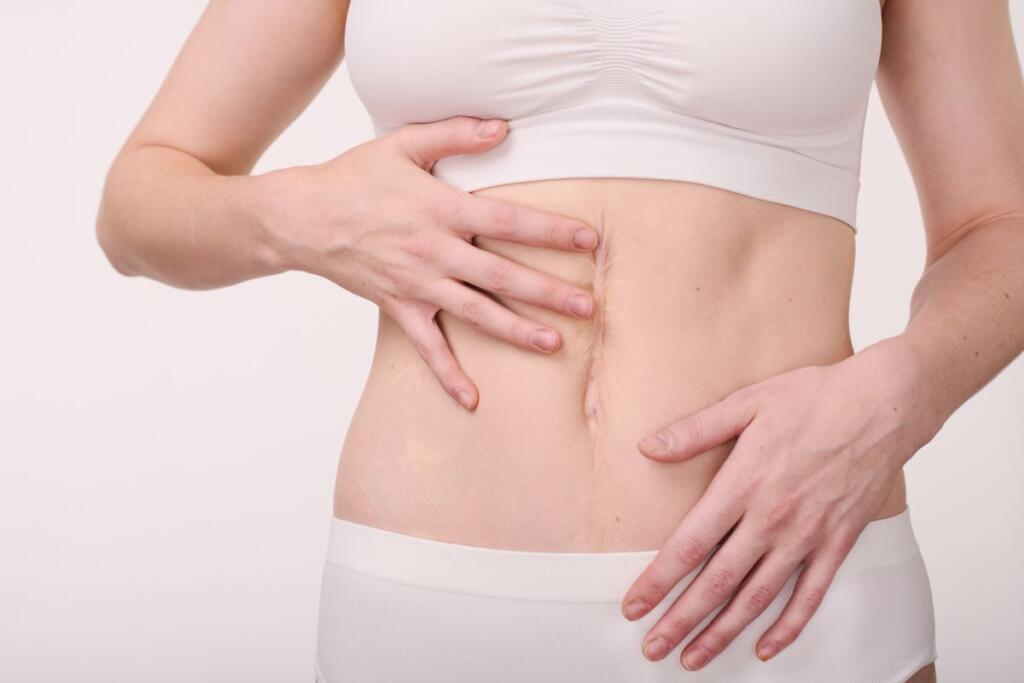 Cos’è il laparocele? Sintomi, cause e quando intervenire con la ...