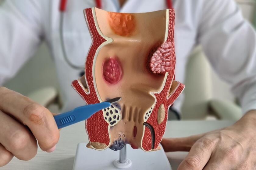 Che differenza c’è tra emorroidi e prolasso rettale? Ecco cosa sapere ...